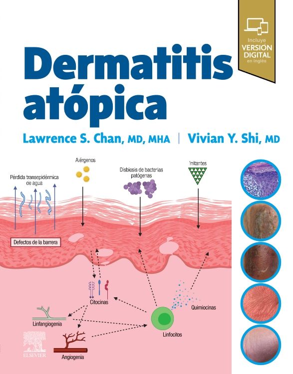 Dermatitis Atópica en LALEO