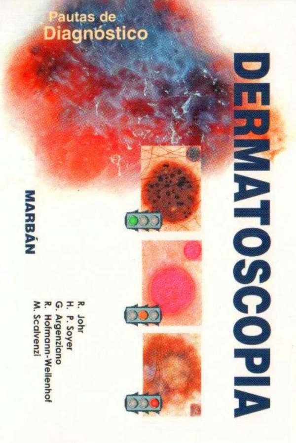 Dermatoscopia Análisis patronales Cinco patrones dermatoscopios ...