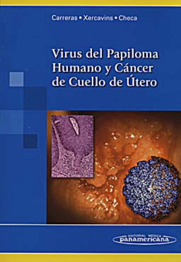 Virus Del Papiloma Humano Y Cancer De Cuello De Utero En Laleo