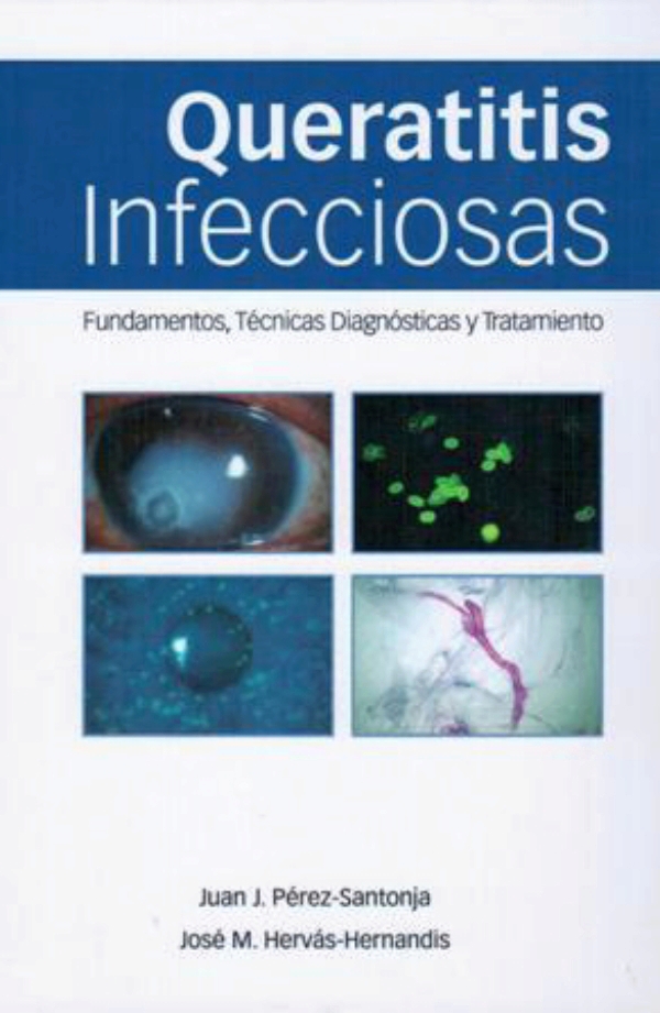 Pérez. Queratitis infecciosa en LALEO