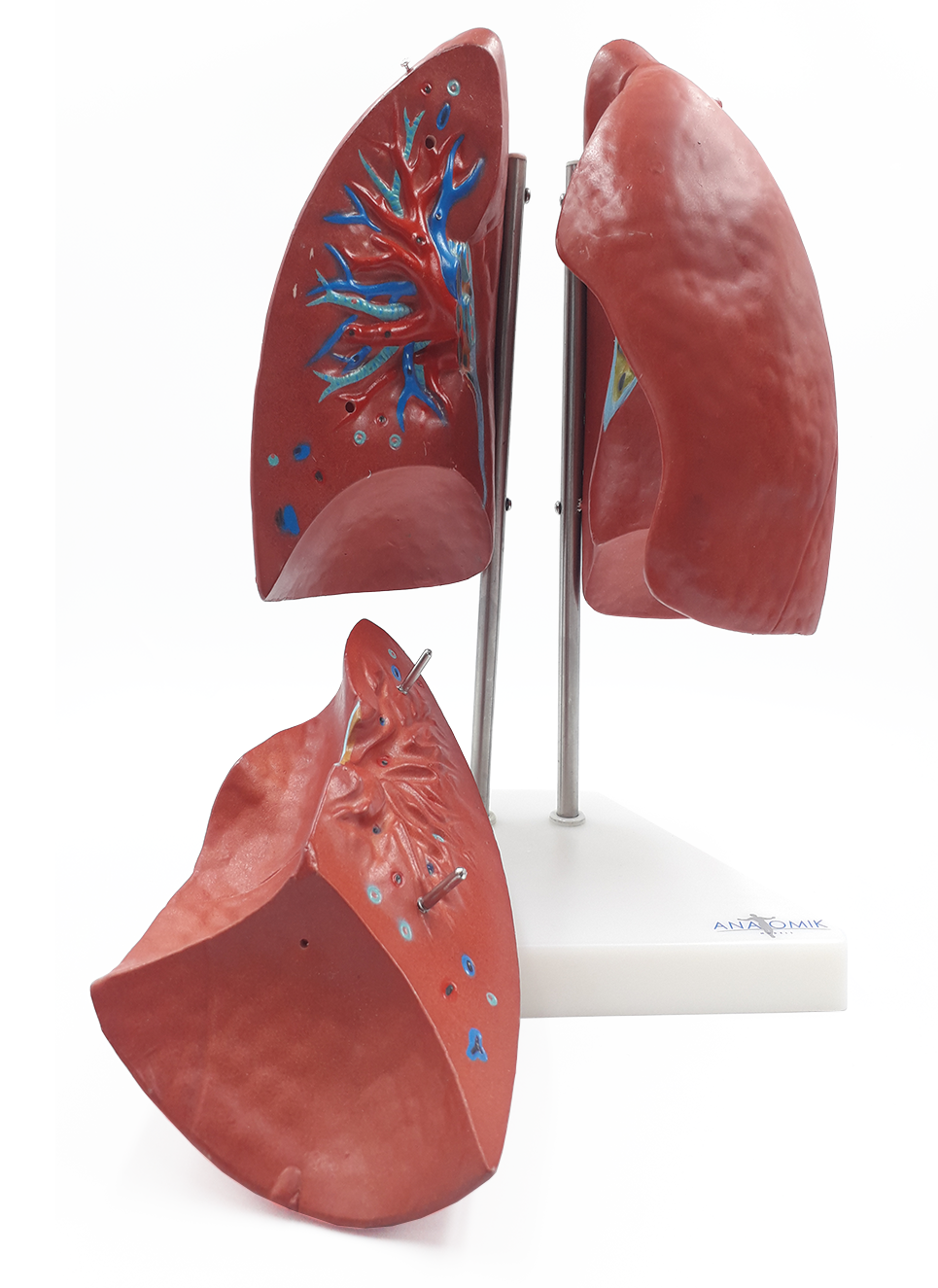 Modelo De Pulmón Tratamiento Del Cáncer De Pulmón De Células No